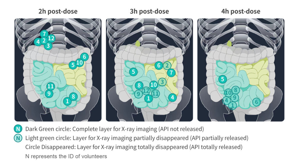 3D-printed drugs: New clinical results for targeted budesonide release